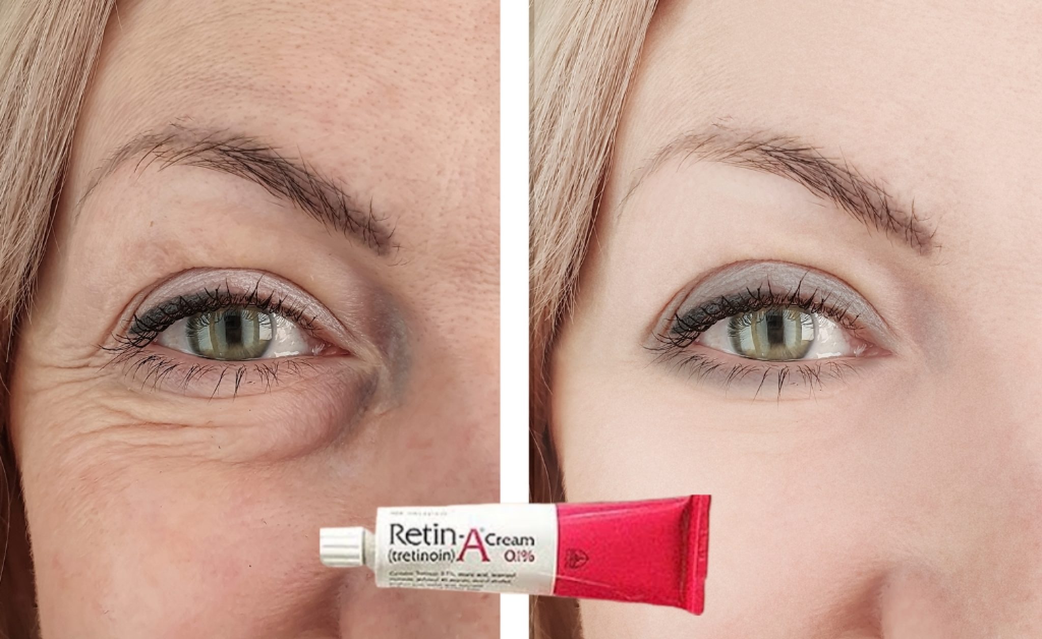 Retin A Before and After:3 Stunning Transformations Unveiled