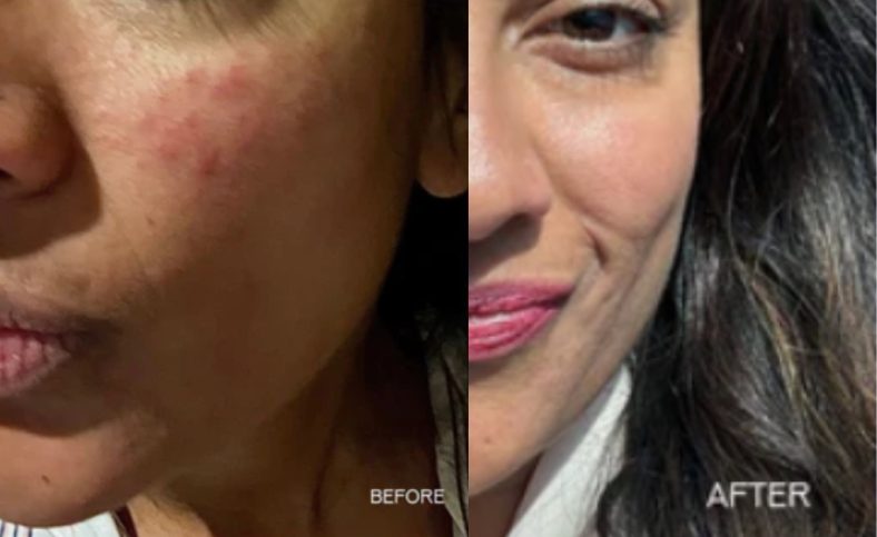 Retin A Before and After:3 Stunning Transformations Unveiled | The ...